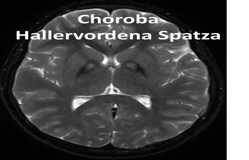 CHOROBA HALLERVORDENA SPATZA objawy przyczyny leczenie zapobieganie ...