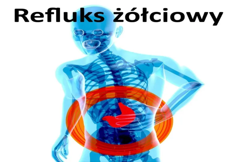 REFLUKS ŻÓŁCIOWY, REFLUKSOWE ZAPALENIE ŻOŁĄDKA objawy leczenie ...